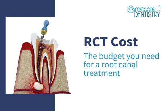Root Canal Treatment Cost in Chembur - RCT Budget in Chembur